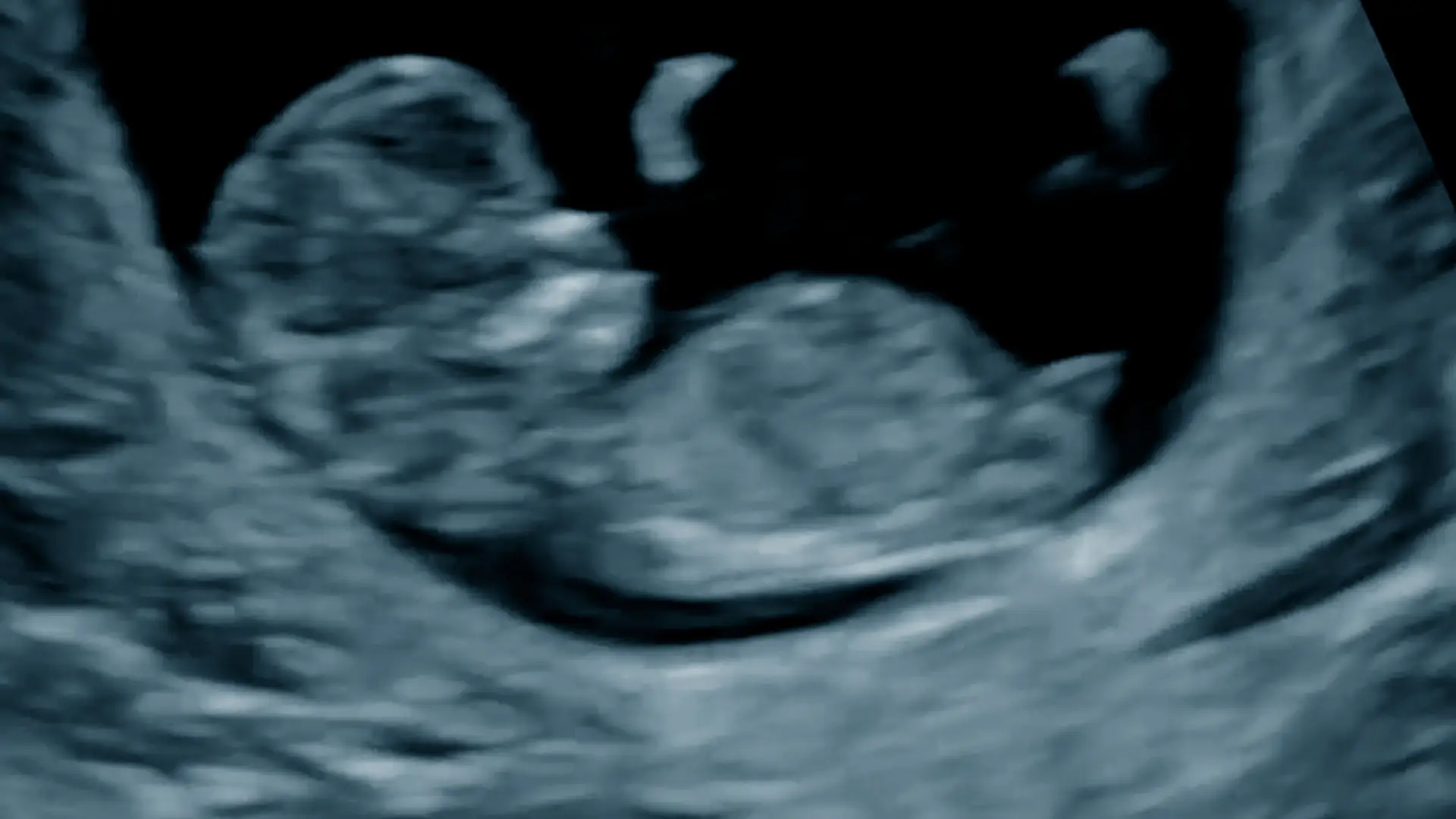 Non-Invasive Prenatal Testing (NIPT Test) - The Ultrasound Suite